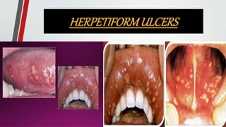 Aphthous ulcer | PPTX
