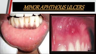 Aphthous ulcer | PPTX