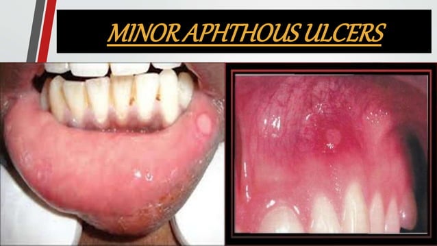 Aphthous ulcer | PPTX | Skin and Dermatology | Diseases and Conditions