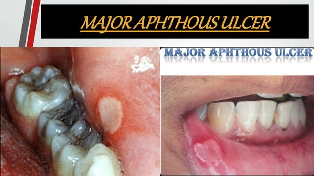 Aphthous ulcer | PPTX | Skin and Dermatology | Diseases and Conditions