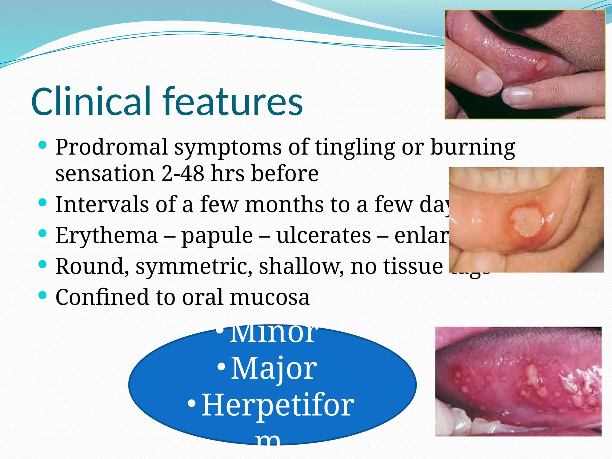 Aphthous ulcer-oral medicine and radiology.pptx