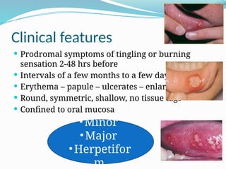 Aphthous ulcer-oral medicine and radiology.pptx