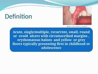 Aphthous ulcer-oral medicine and radiology.pptx