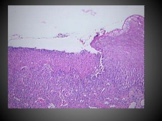 Aphthous Stomatitis Histology