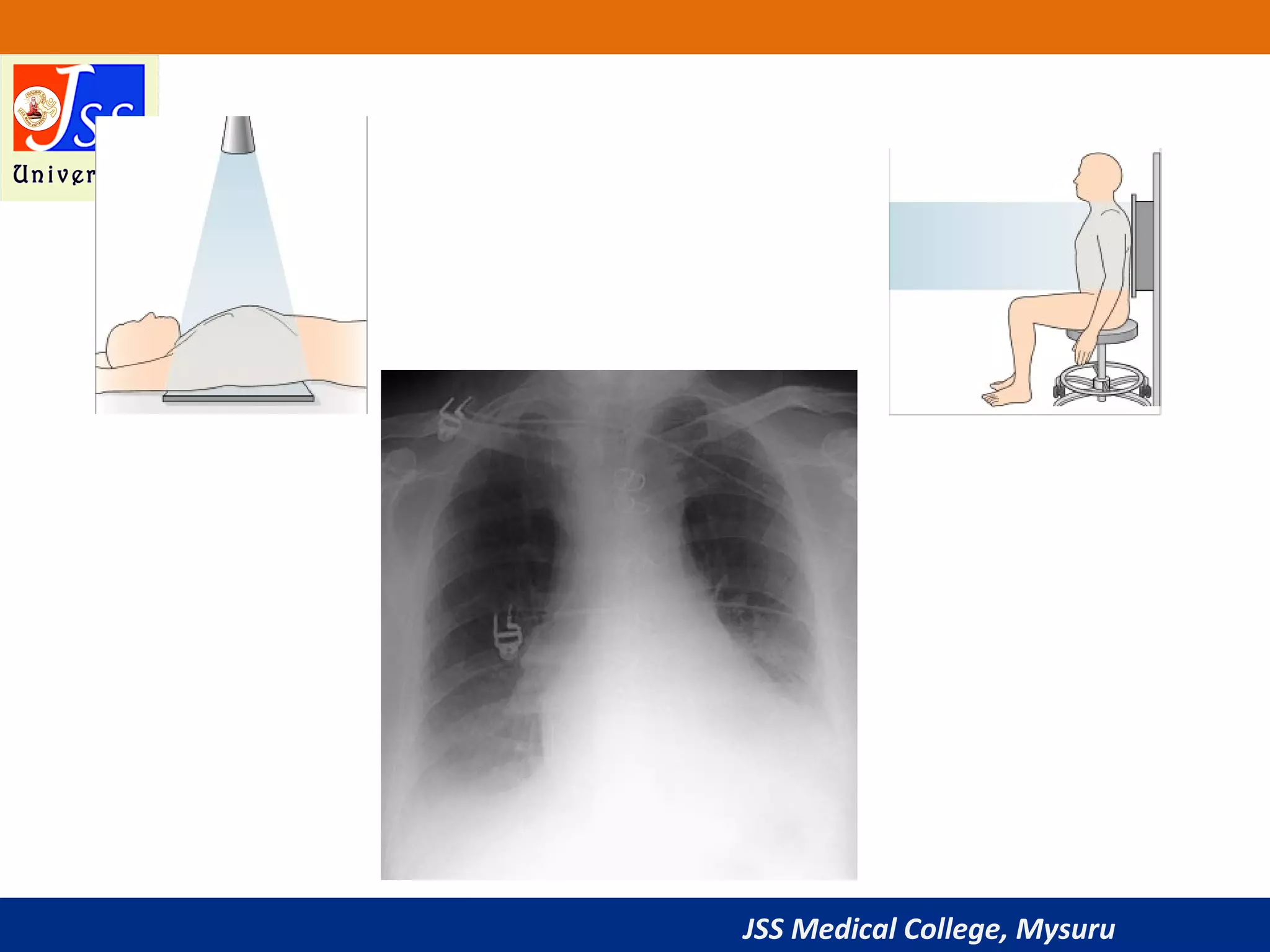 Approach to Chest X-Ray and Interpretation | PPT