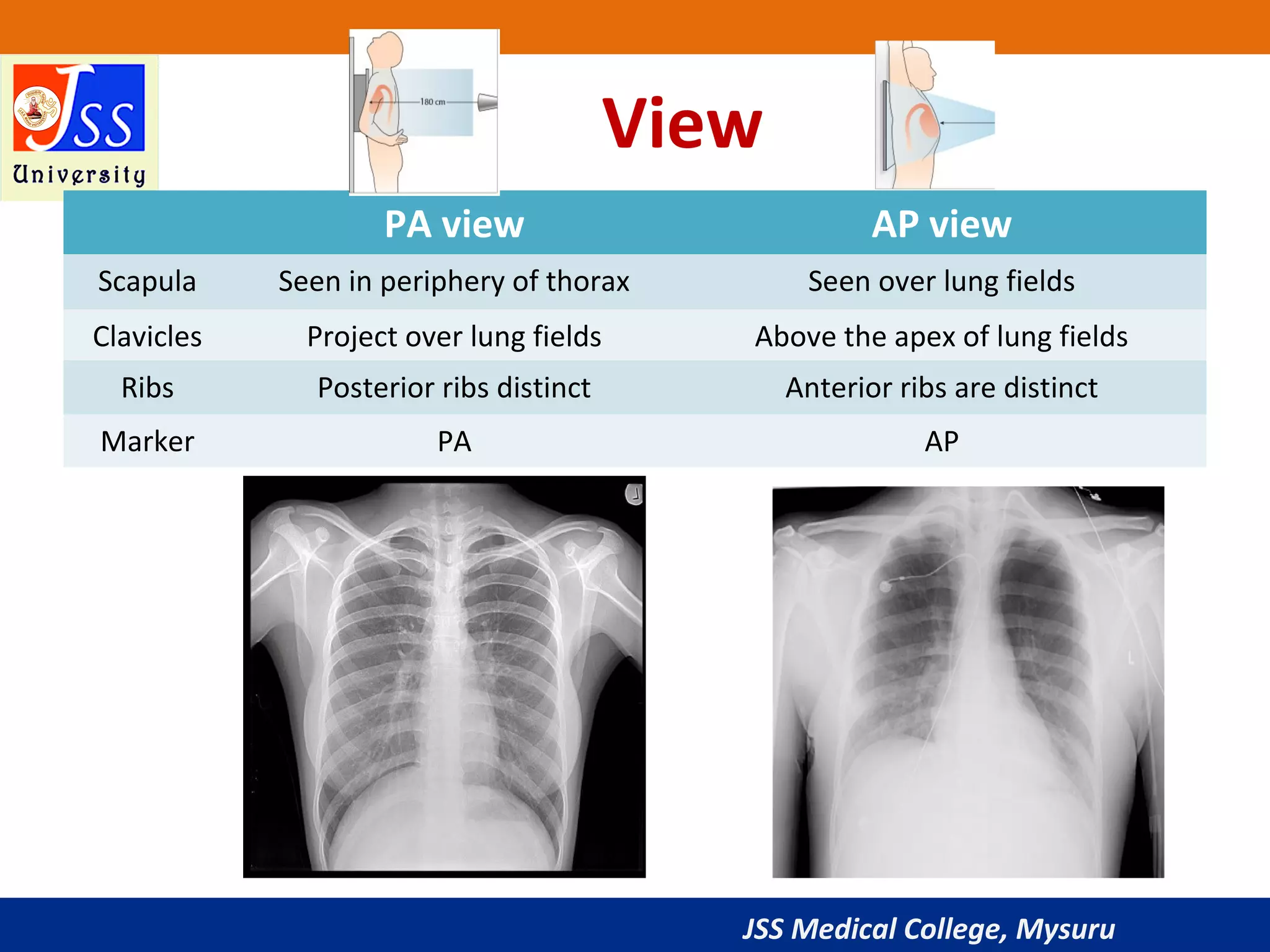 Approach to Chest X-Ray and Interpretation | PPT