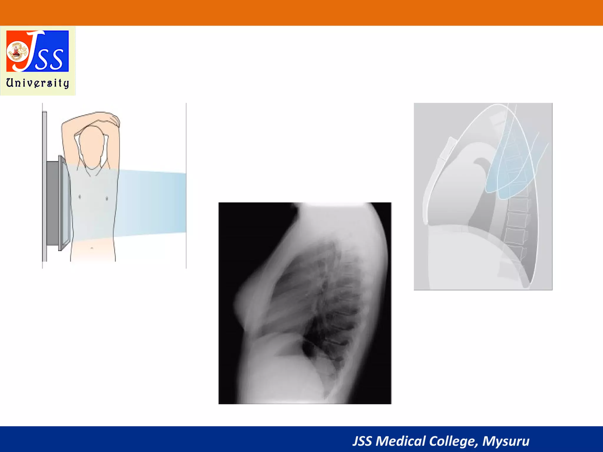 Approach to Chest X-Ray and Interpretation | PPT