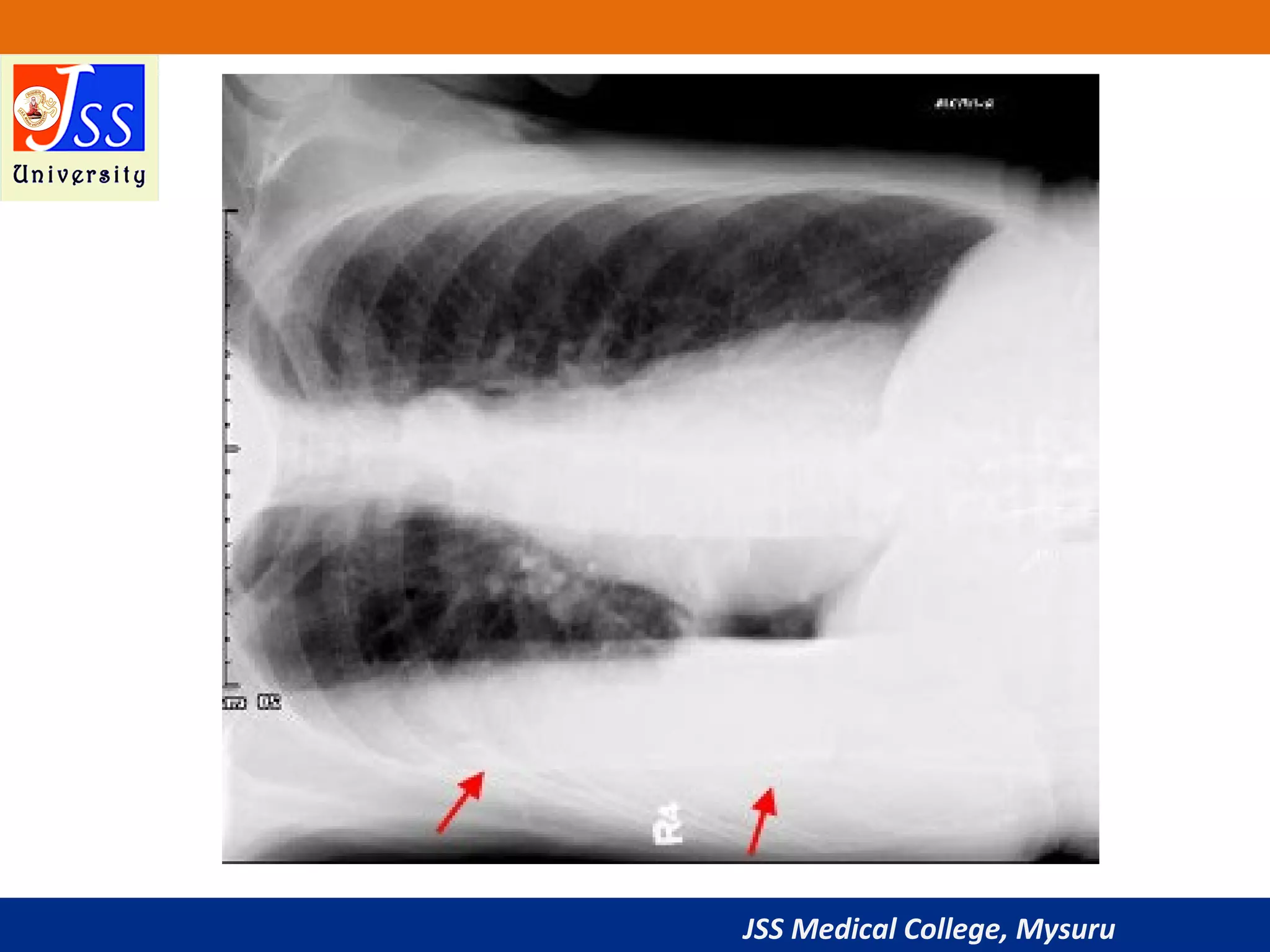 Approach to Chest X-Ray and Interpretation | PPT