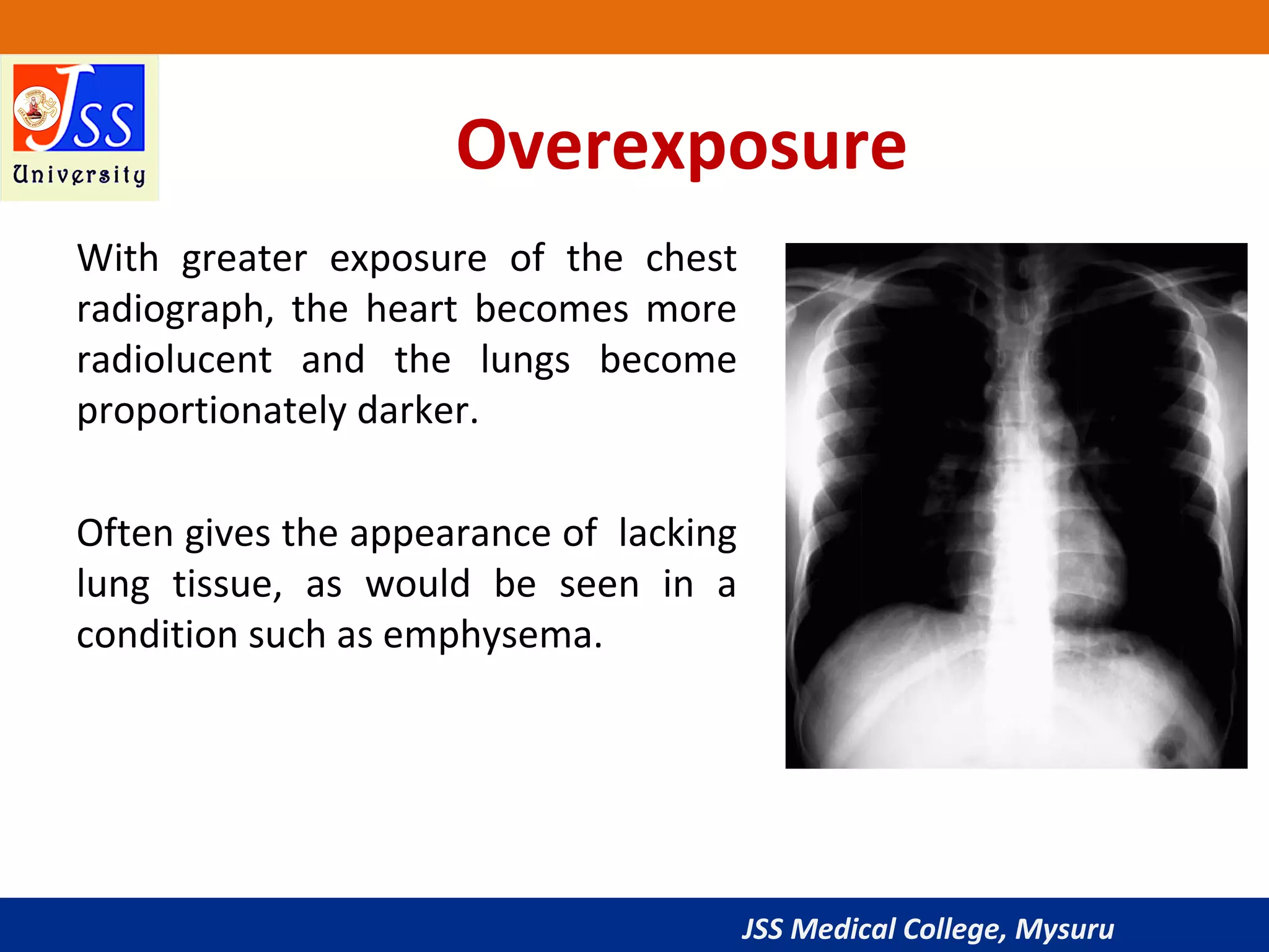 Approach to Chest X-Ray and Interpretation | PPT