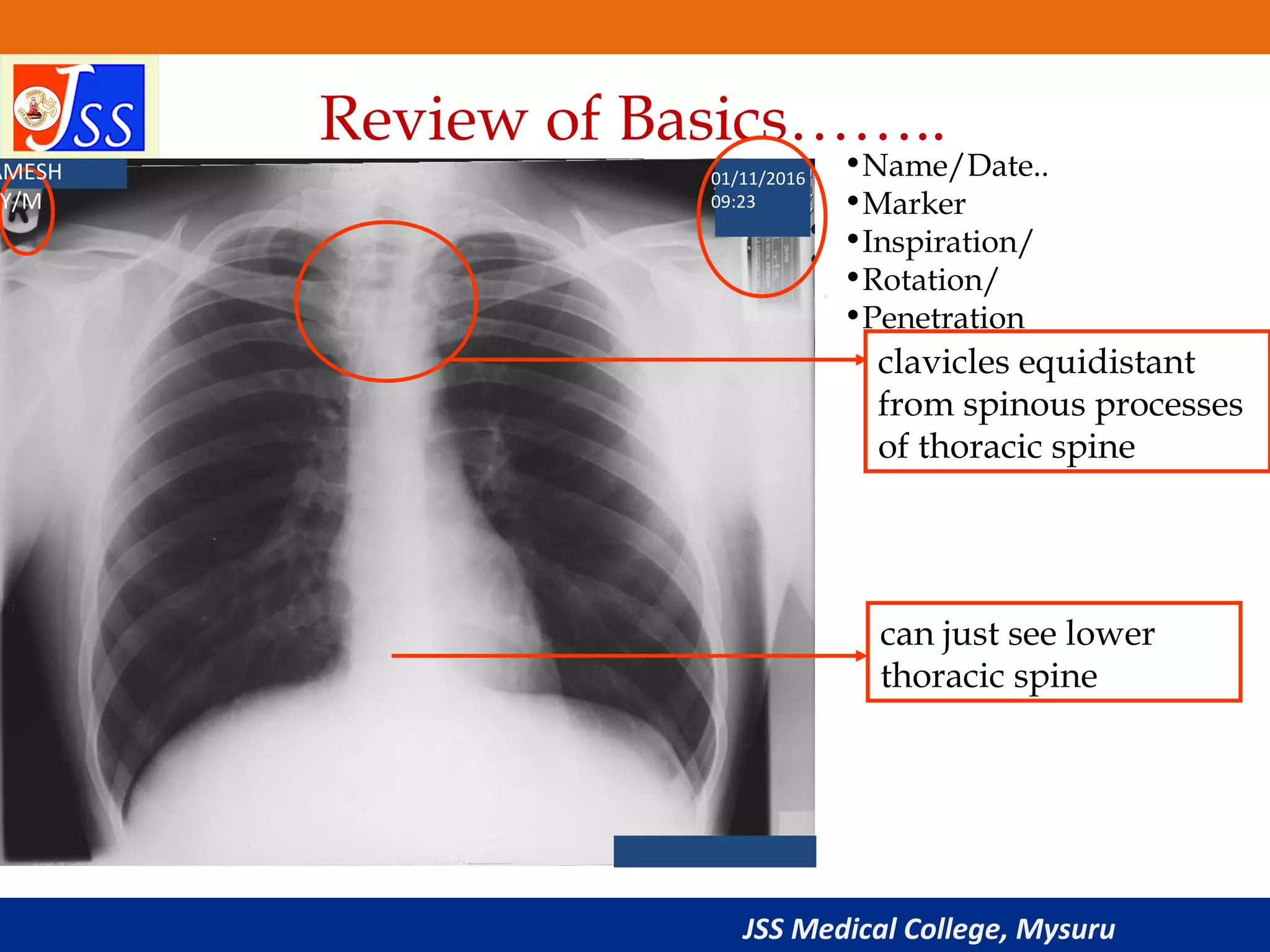 Approach to Chest X-Ray and Interpretation | PPT