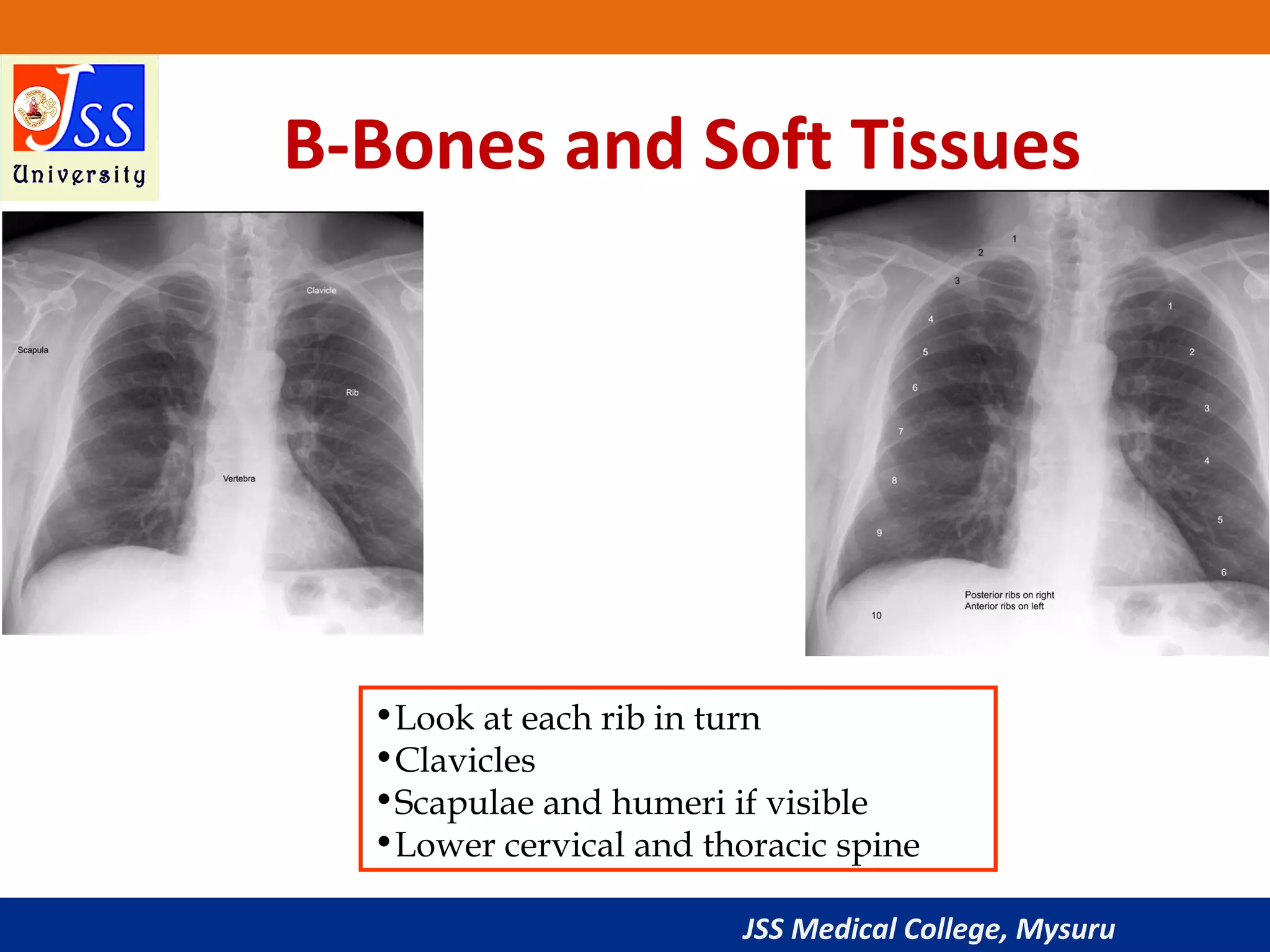 Approach to Chest X-Ray and Interpretation | PPT