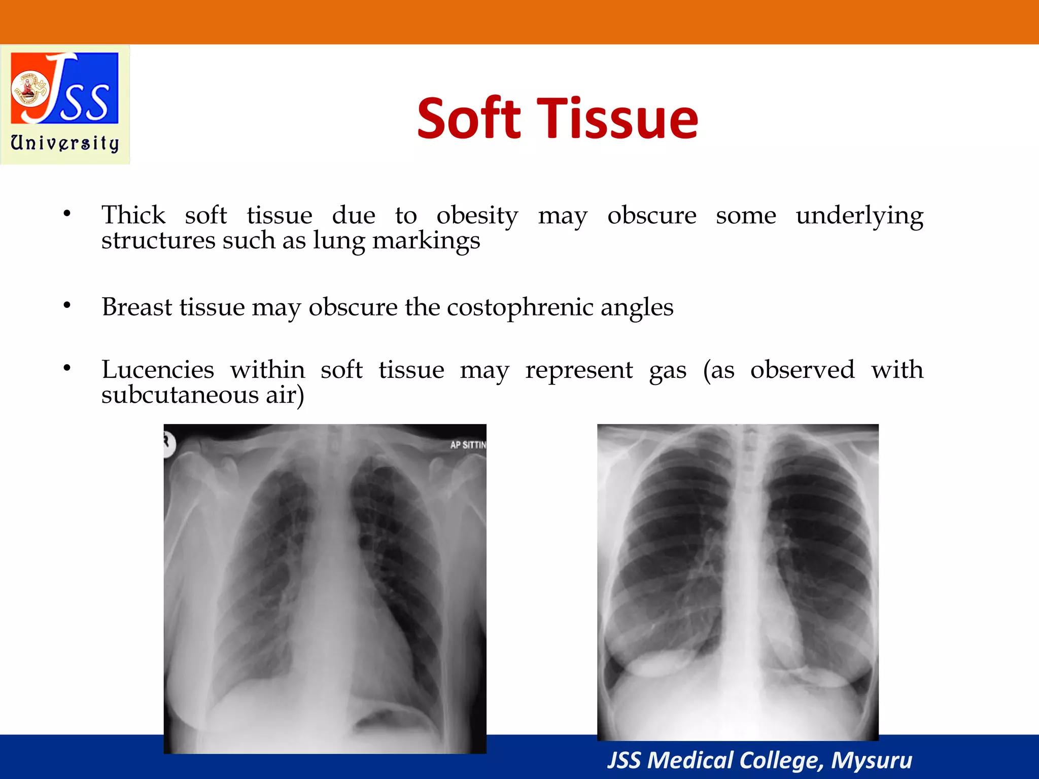 Approach to Chest X-Ray and Interpretation | PPT
