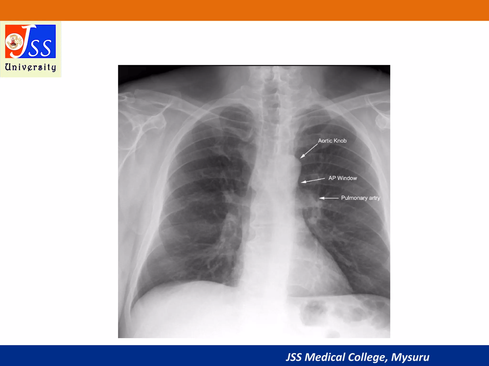 Approach to Chest X-Ray and Interpretation | PPT