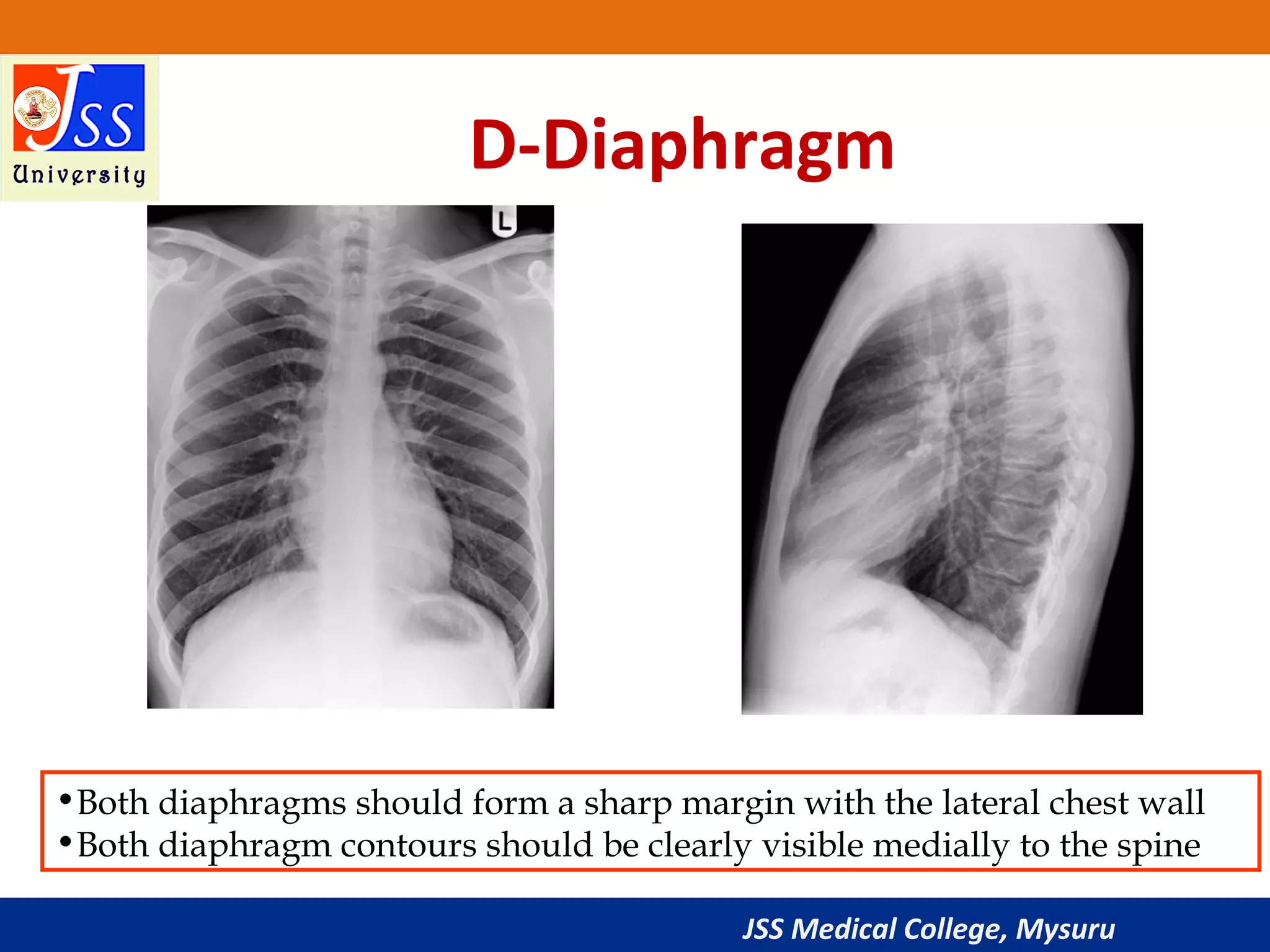 Approach to Chest X-Ray and Interpretation | PPT