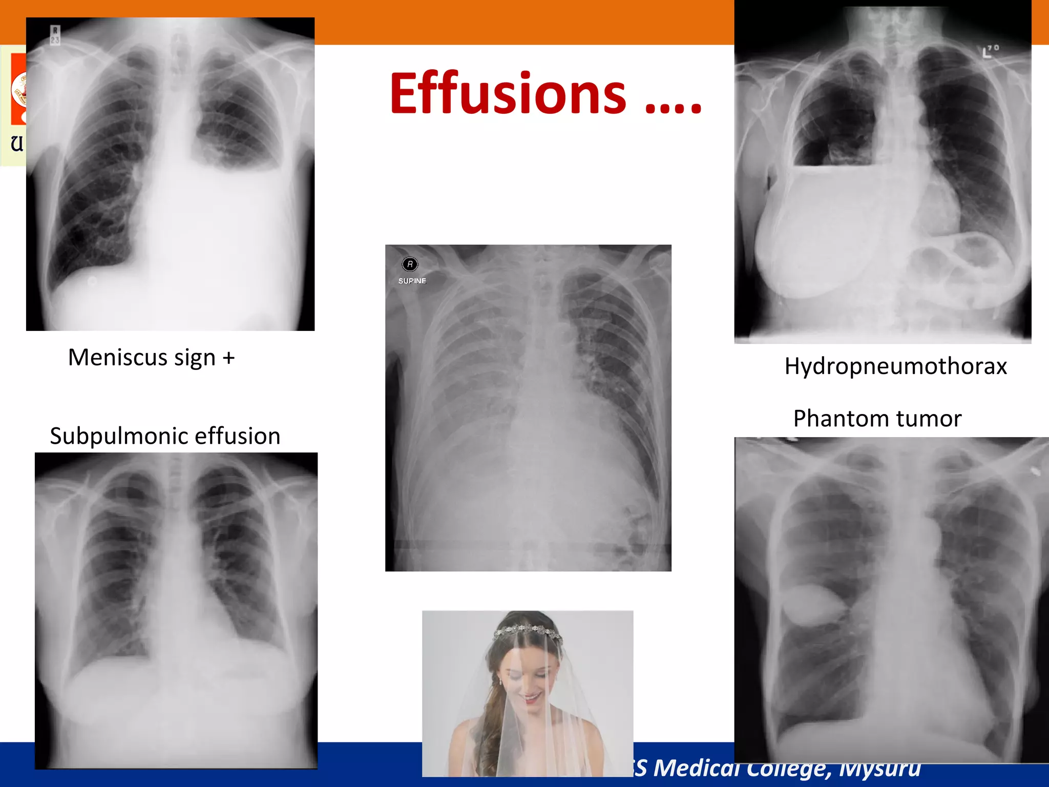 Approach to Chest X-Ray and Interpretation | PPT