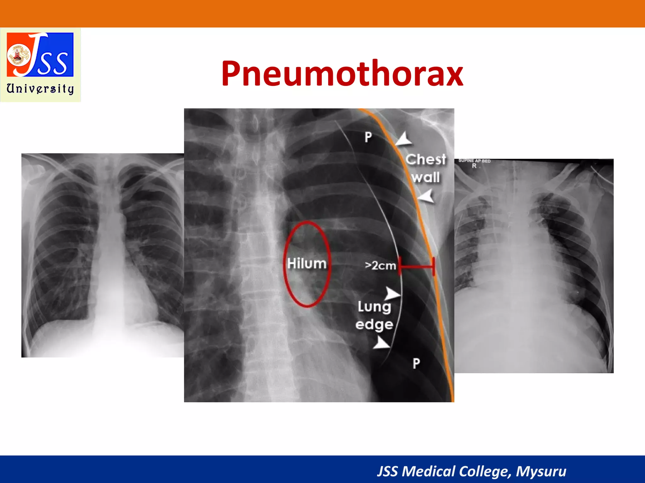 Approach to Chest X-Ray and Interpretation | PPT