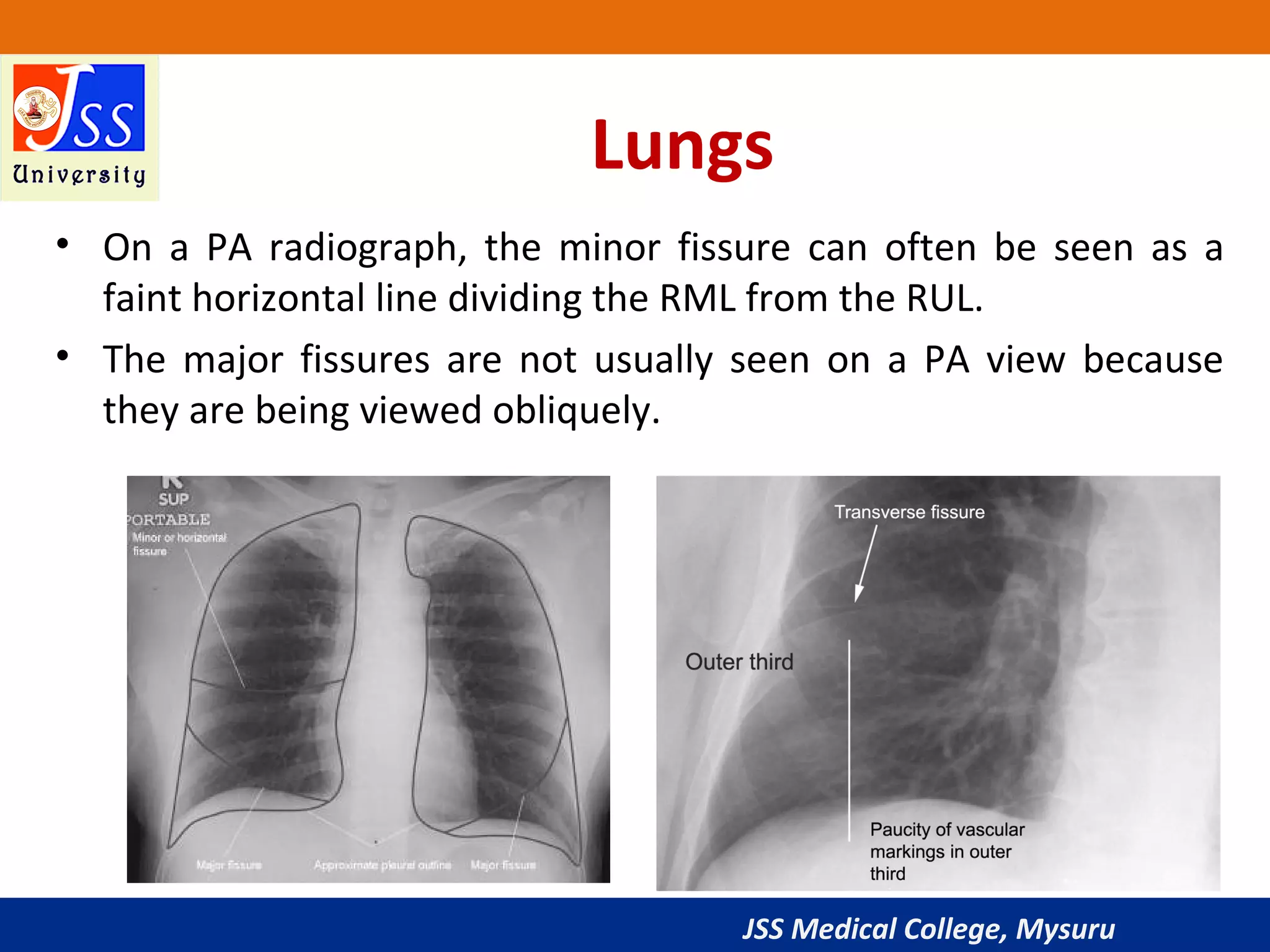 Approach to Chest X-Ray and Interpretation | PPT