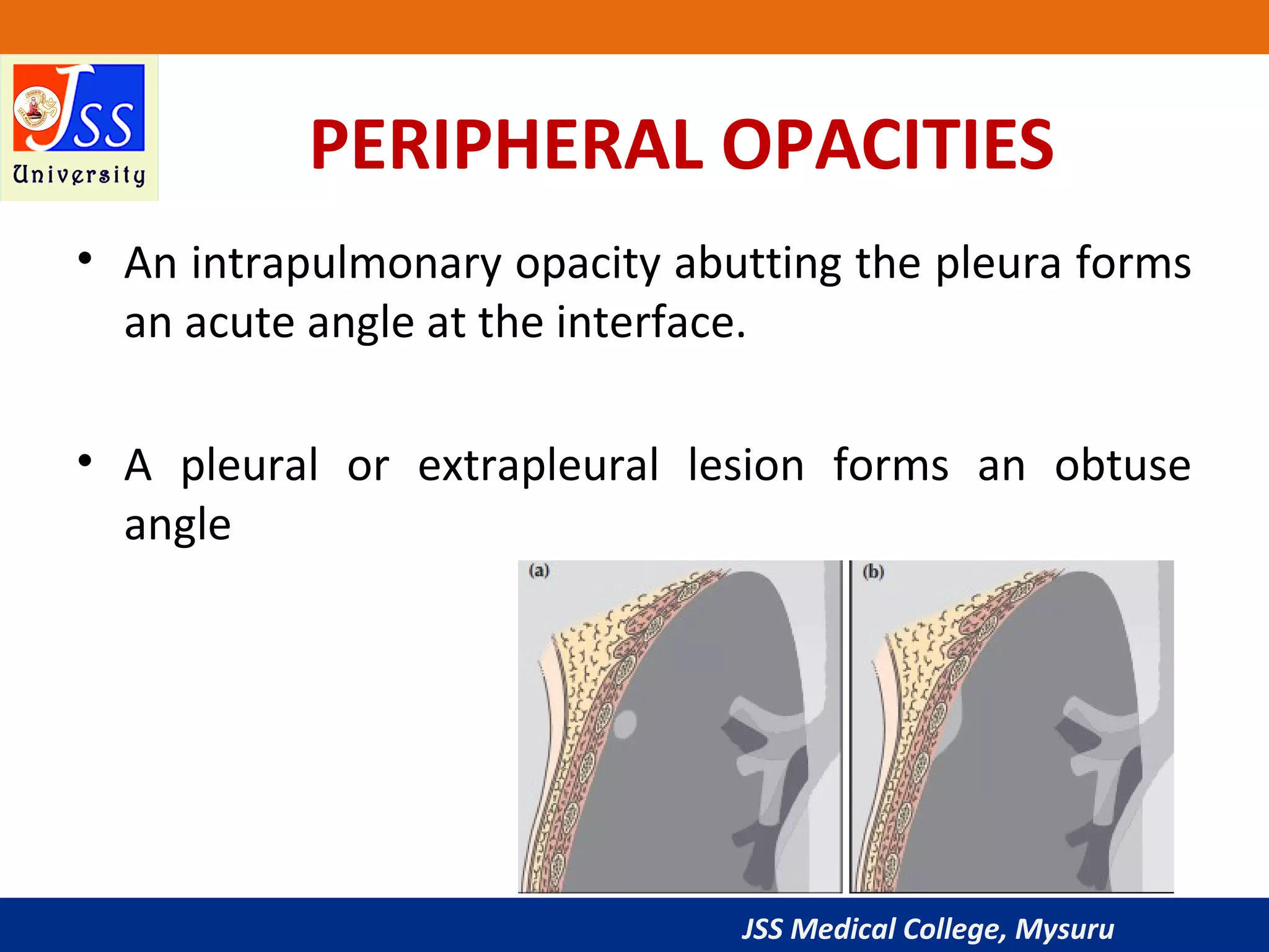 Approach to Chest X-Ray and Interpretation | PPT