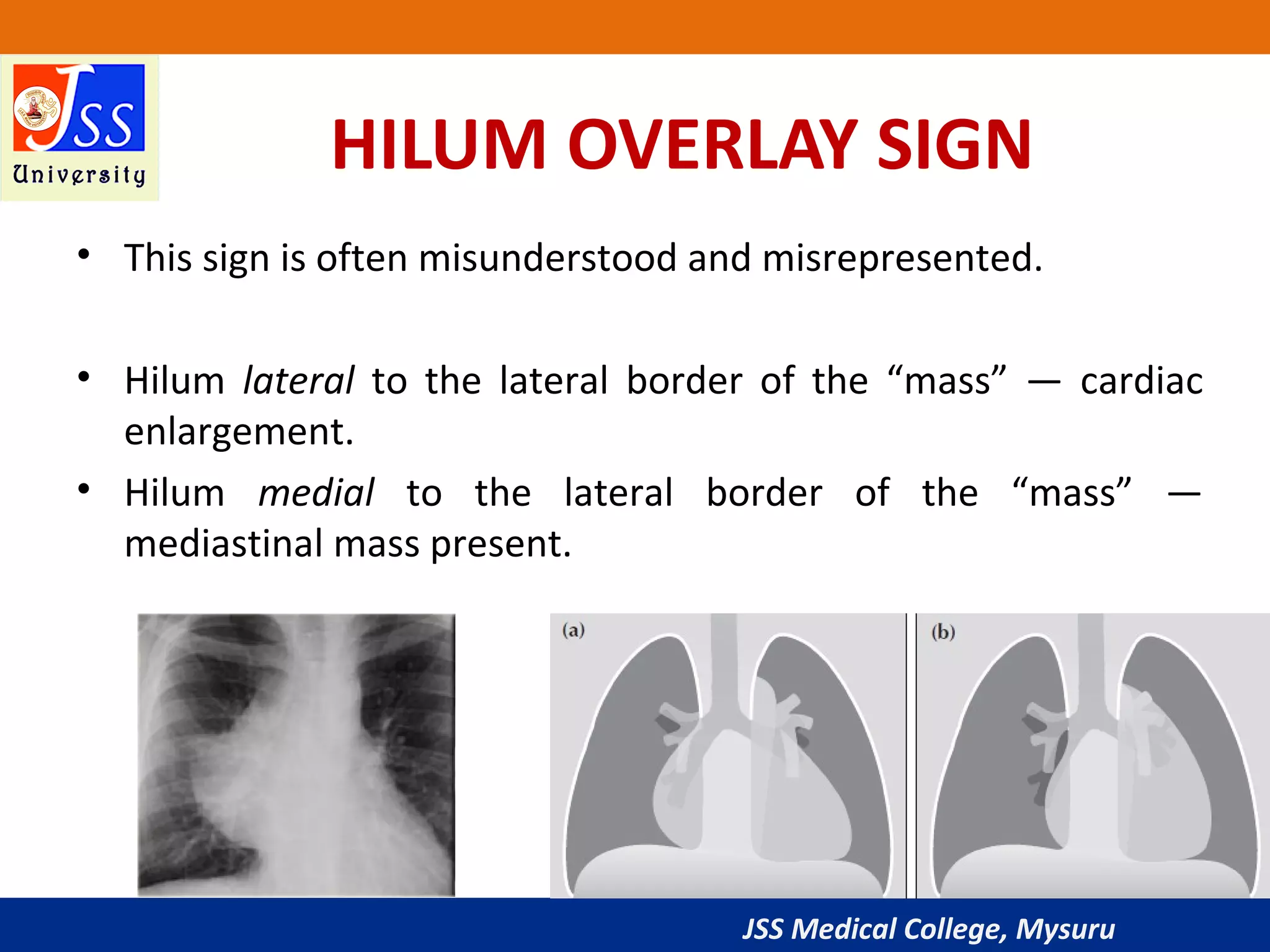 Approach to Chest X-Ray and Interpretation | PPT