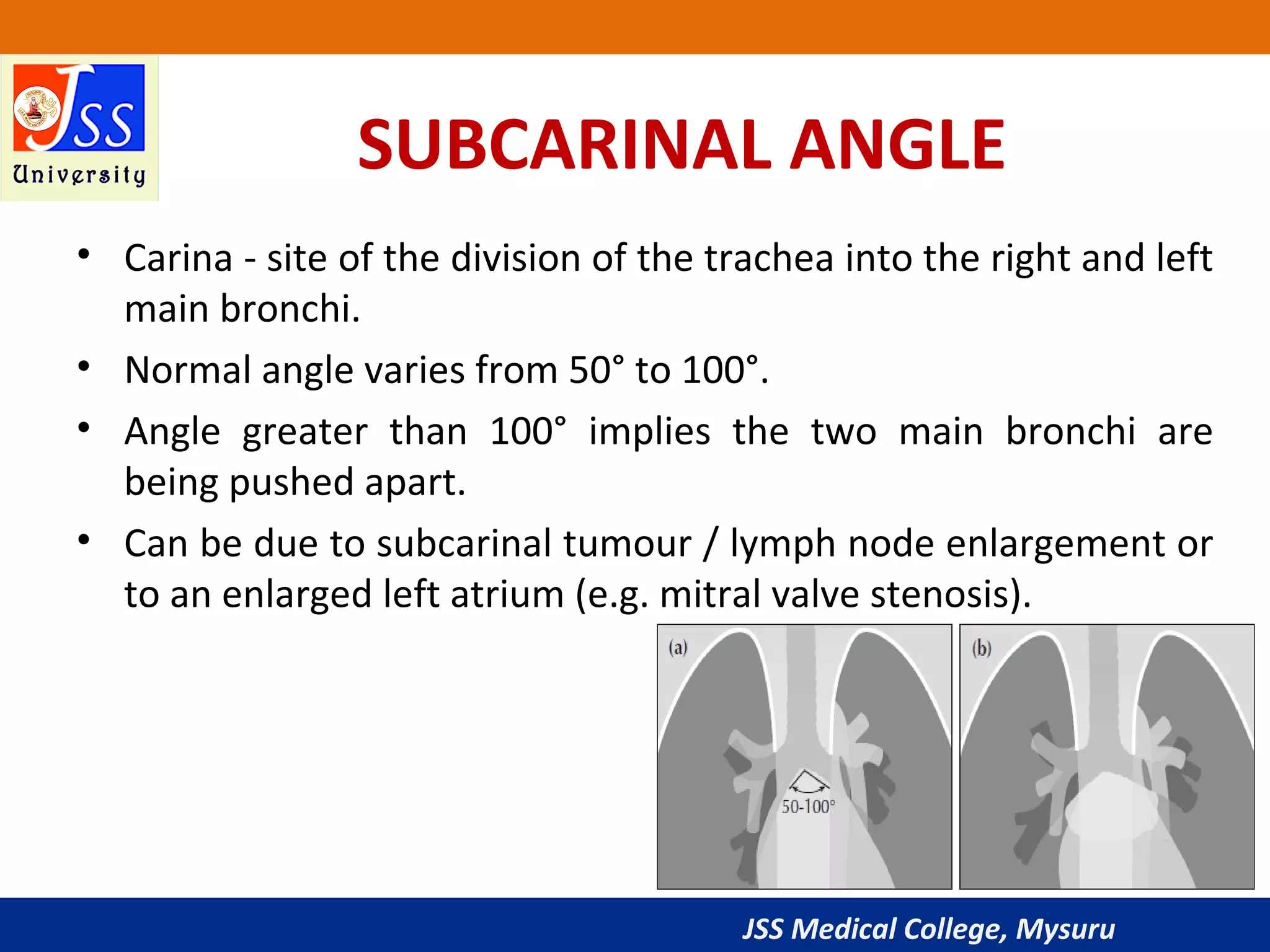 Approach to Chest X-Ray and Interpretation | PPT