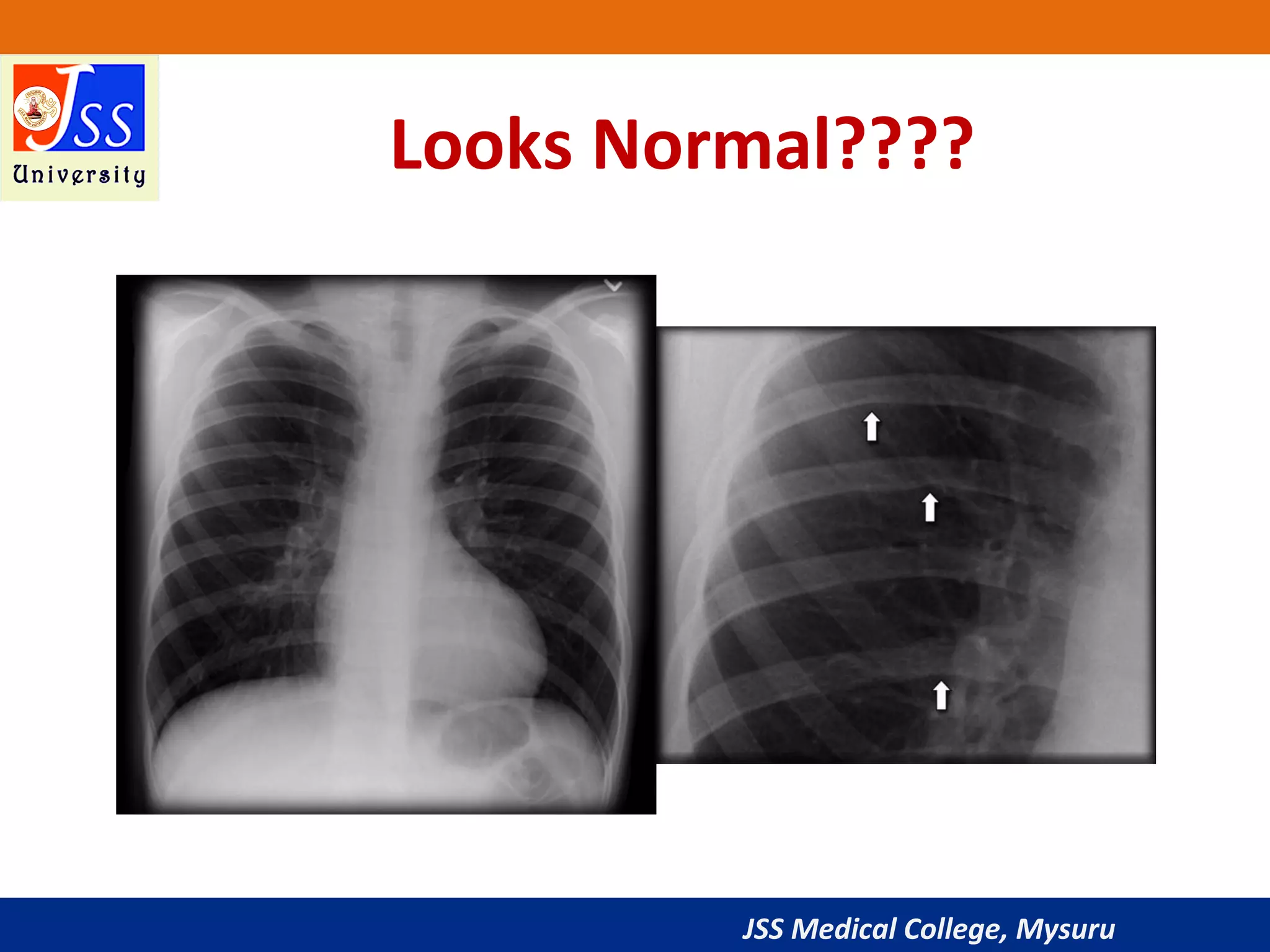 Approach to Chest X-Ray and Interpretation | PPT
