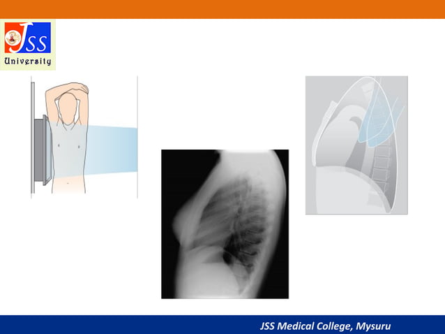 Approach to Chest X-Ray and Interpretation | PPT