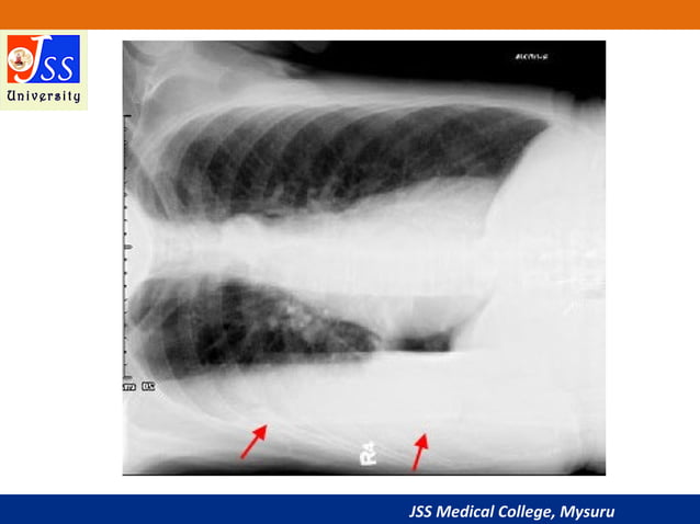 Approach to Chest X-Ray and Interpretation | PPT