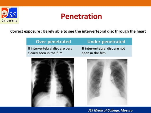 Approach to Chest X-Ray and Interpretation | PPT