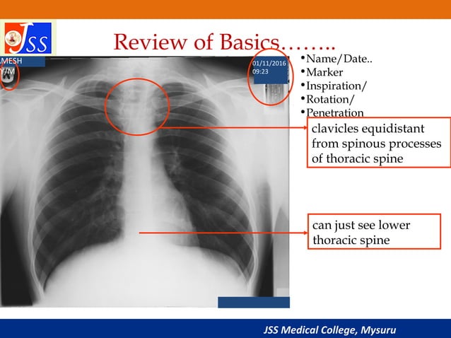 Approach to Chest X-Ray and Interpretation | PPT