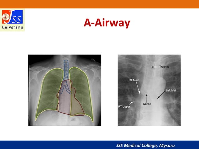Approach to Chest X-Ray and Interpretation | PPT
