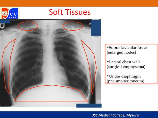 Approach to Chest X-Ray and Interpretation | PPT