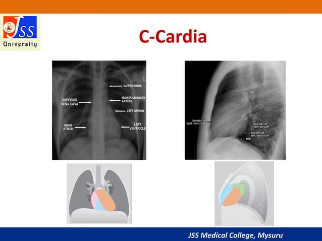 Approach to Chest X-Ray and Interpretation | PPT
