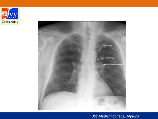 Approach to Chest X-Ray and Interpretation | PPT