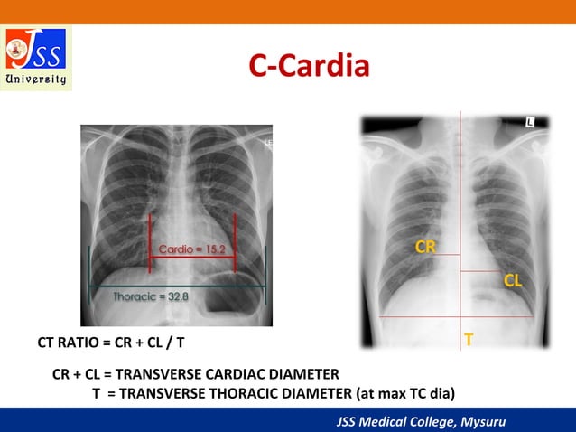 Approach to Chest X-Ray and Interpretation | PPT