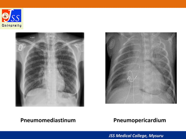 Approach to Chest X-Ray and Interpretation | PPT