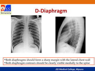 Approach to Chest X-Ray and Interpretation | PPT