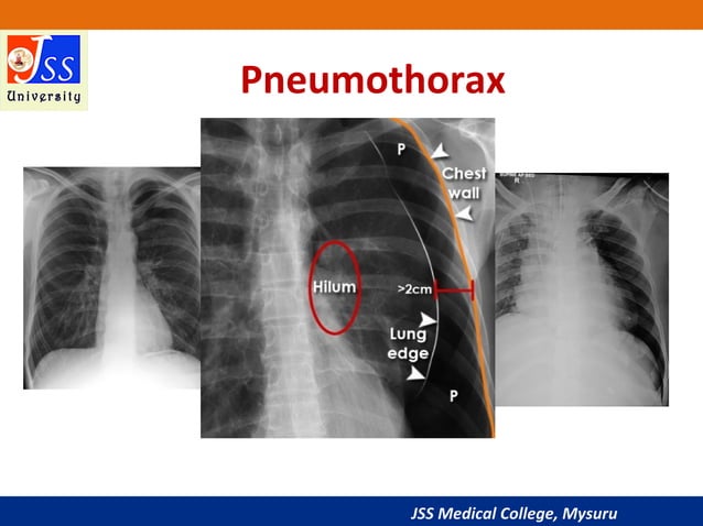 Approach to Chest X-Ray and Interpretation | PPT