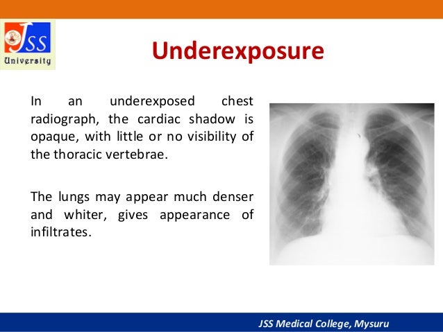 Approach to Chest X-Ray and Interpretation