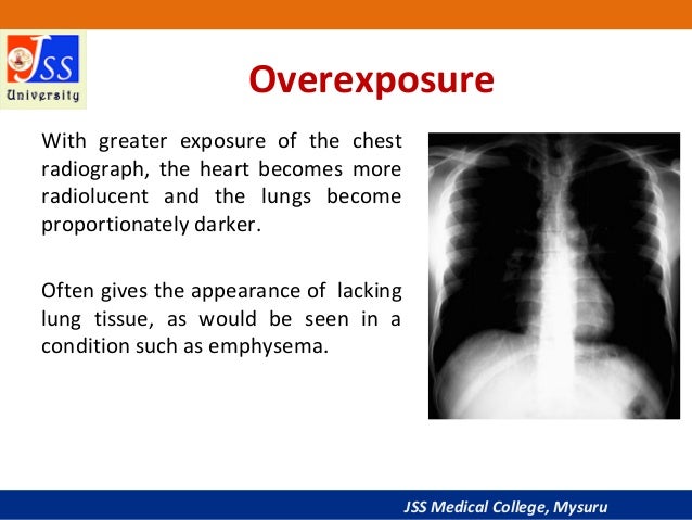 Approach to Chest X-Ray and Interpretation