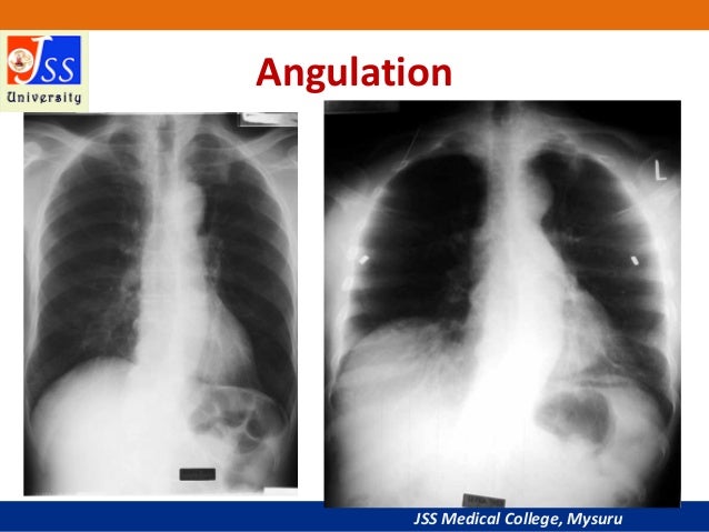 Approach to Chest X-Ray and Interpretation