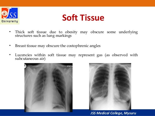 Approach to Chest X-Ray and Interpretation