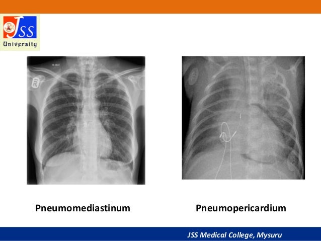 Approach to Chest X-Ray and Interpretation