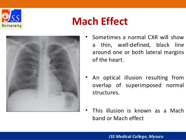 Approach to Chest X-Ray and Interpretation