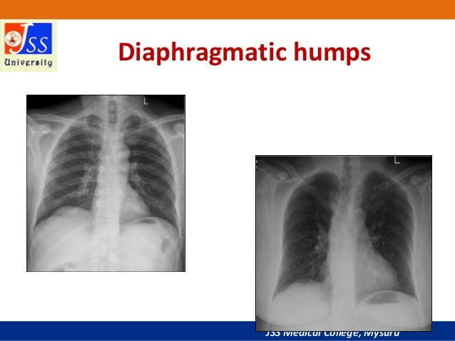 Approach to Chest X-Ray and Interpretation