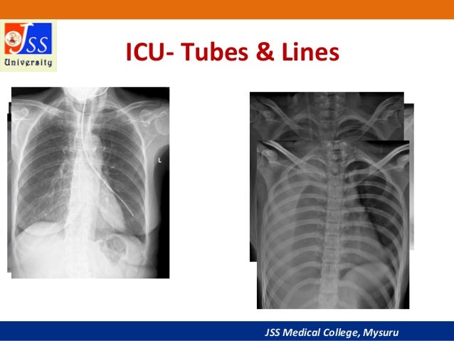Approach to Chest X-Ray and Interpretation
