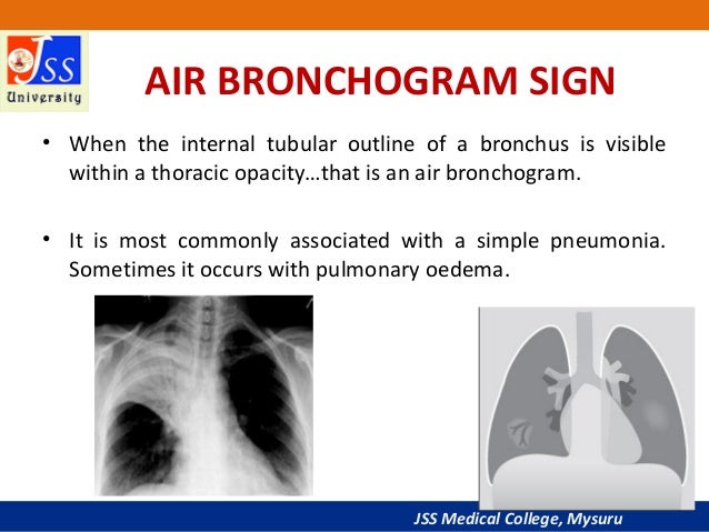 Approach to Chest X-Ray and Interpretation
