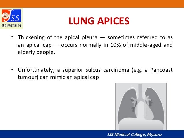 Approach to Chest X-Ray and Interpretation