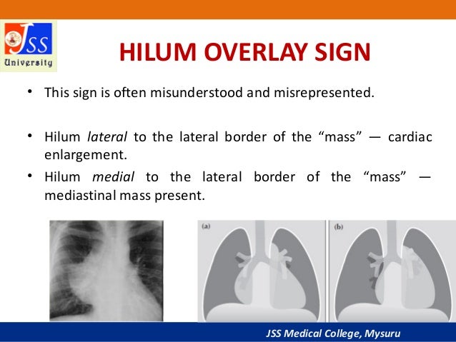 Approach to Chest X-Ray and Interpretation