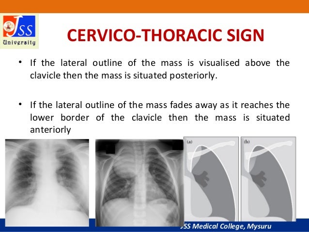 Approach to Chest X-Ray and Interpretation
