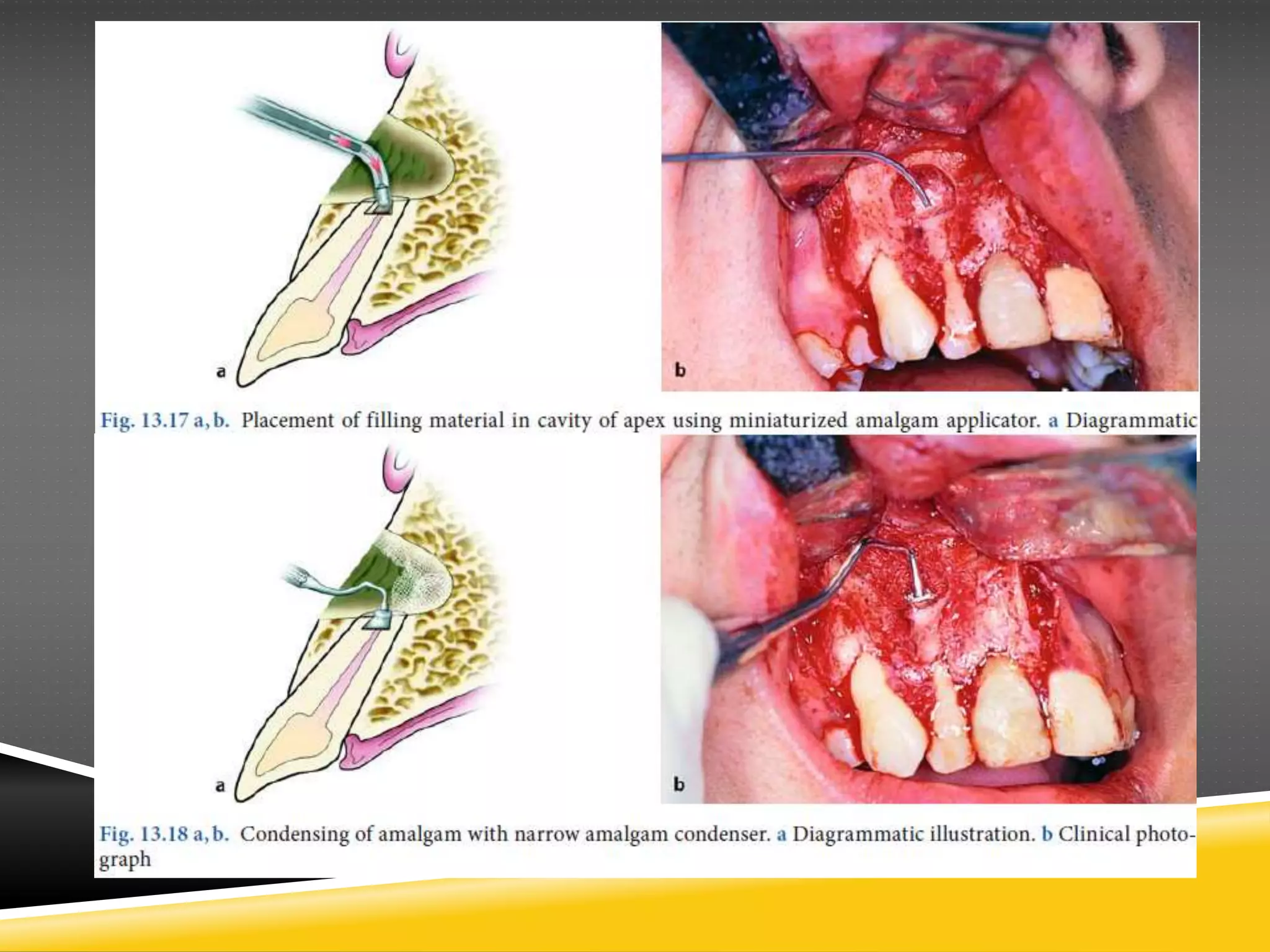 apicoectomy | PPTX